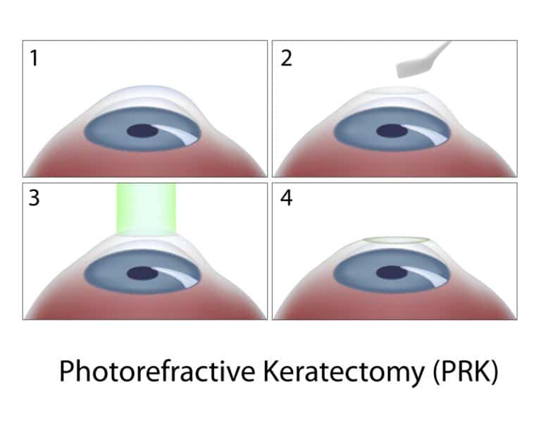 Benefits of PRK Eye Surgery | Eye Specialist in Ohio | ClearChoice