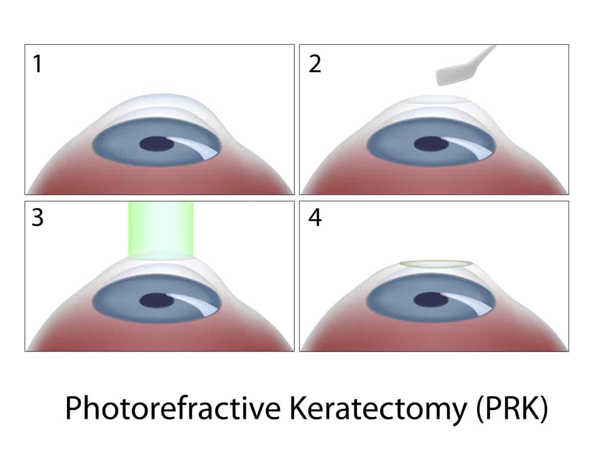 Benefits of PRK Eye Surgery | Eye Specialist in Ohio | ClearChoice